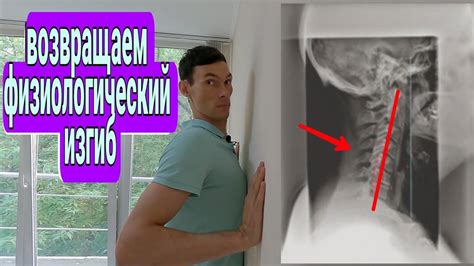 ЧЕМ ОПАСЕН СГЛАЖЕННЫЙ ШЕЙНЫЙ ЛОРДОЗ упражнения Lordosis Exercise