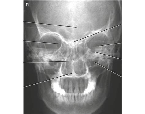 Pa Axial Caldwell Facial Bones Quiz
