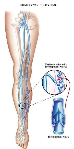 Varicose Veins Feet