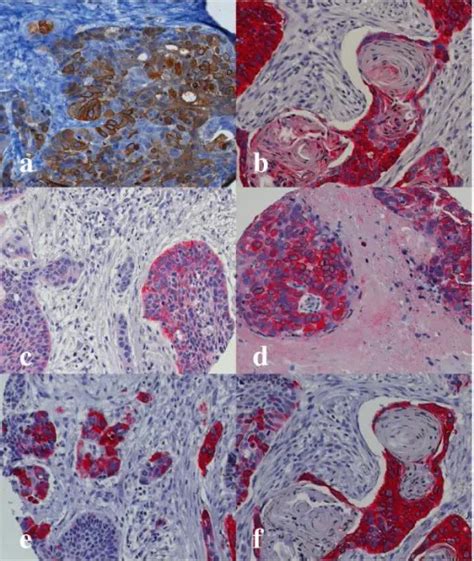 What Is Squamous Cell Carcinoma Of The Oral Cavity Pathosomes