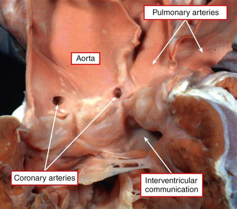 Common Arterial Trunk Clinical Tree