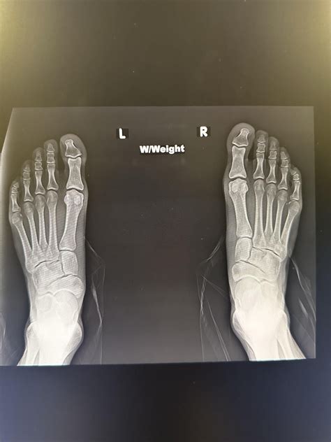 How Many Sesamoid And Accessory Ossicles Can You Find R Xrayporn