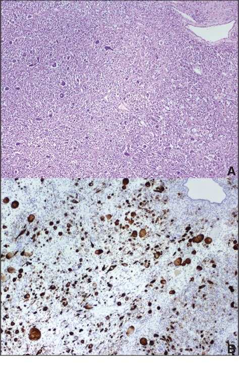 Figure 3 From A New Case Of Malignant Mixed Epithelial And Stromal