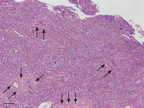 Low Power Photomicrograph Of Liver Tissue Demonstrating Disruption To
