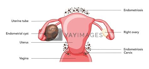 Ovarian Endometriomas Chocolate Cysts Female Reproductive System Uterus