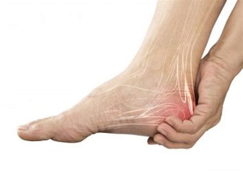 Exostosis Of Foot