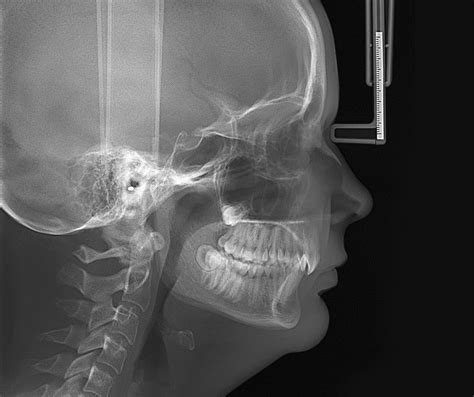 Dexis Op 3d™ Mcf Solutions