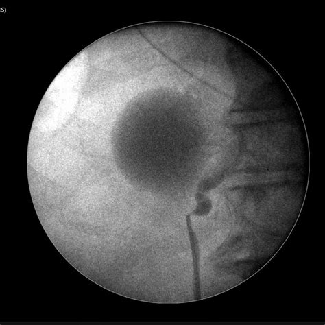 Intraoperative Images Showing Retrograde Pyelogram Delignating The