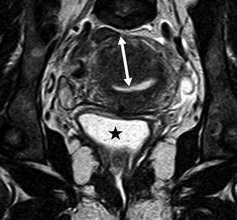Retroflexed Uterus Mri