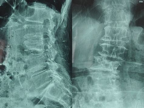 Posterior Fusion For Lumbar Scoliosis Assisted With Perlove Medicals