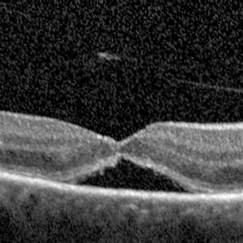 Spectral Domain Optical Coherence Tomography Image Of The Left Eye In