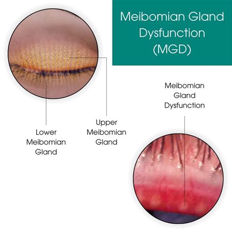 Meibomian Gland Dysfunction Treatment Nyc Mgd Specialists Downtown Manhattan