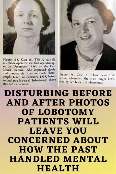 Disturbing Before And After Photos Of Lobotomy Patients Will Leave You Concerned About How The