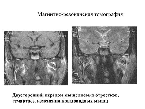 Височно нижнечелюстной сустав МРТ исследование презентация онлайн
