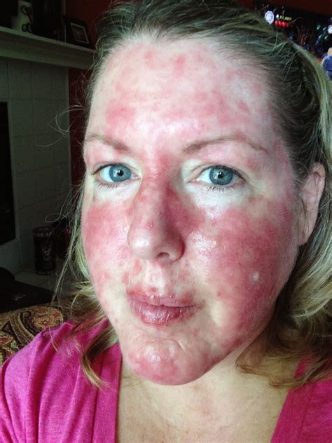 My Journey Through Topical Chemotherapy Fluorouracil 5 Cream And