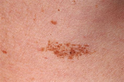 What Is A Nevus Spilus Birthmark