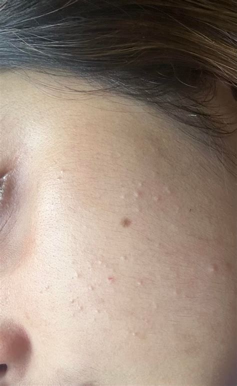 Myanmar Beauty Reviews အခုတော်တော်များဖြစ်နေကြတဲ့ အဆီဖု တွေအများကြီးထ