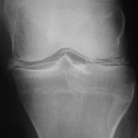 Plain Radiograph Showing Calcification Within The Hip Capsule Arrows