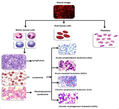 Leukemia Cells Diagram
