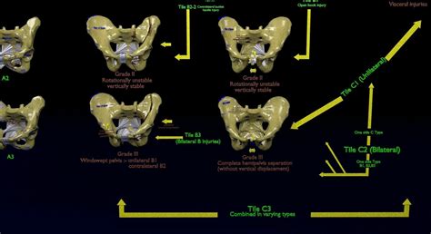 Pelvis Fracture Classifications 3d Model Superhive Formerly Blender