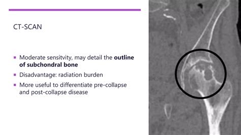 Avascular Necrosis Of The Hip Ppt