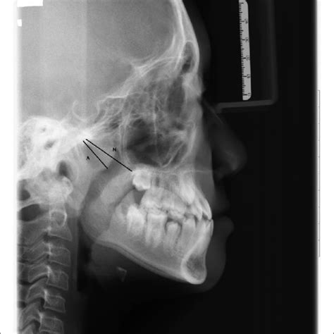 Calculating The Adenoidal Nasopharyngeal An Ratio On A Lateral