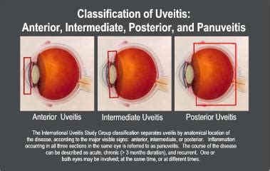 Classifymed Uveitis Org OIUF