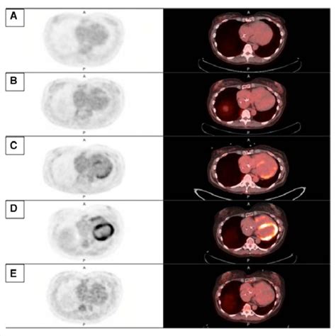F 18 Fluorodeoxyglucose 18 F Fdg Cardiac Positron Emission