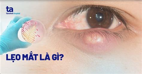 Mụt Lẹo Mắt Nguyên Nhân Dấu Hiệu Chẩn đoán Và Phòng Ngừa