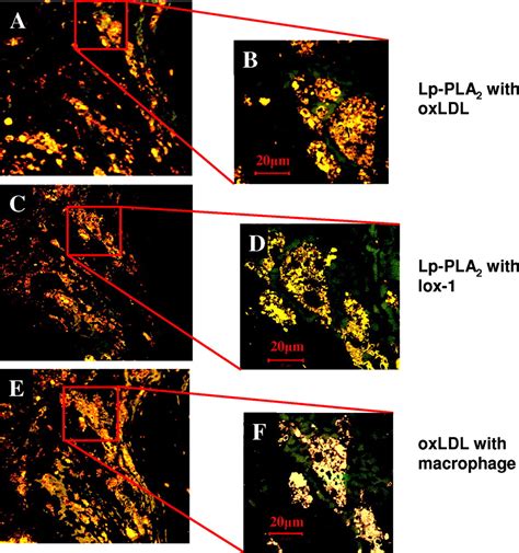 Enhanced Expression Of Lp Pla2 And Lysophosphatidylcholine In