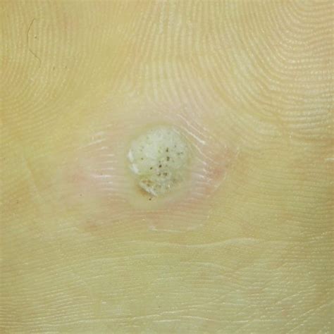 Wart Plantar Icd 10 B07 Online Consultation Ai Dermatologist