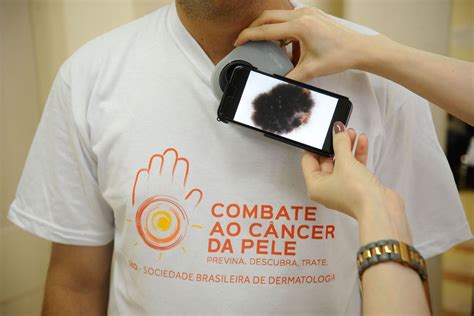 Mutir O Faz Diagn Stico Precoce De C Ncer De Pele Em Todo O Pa S