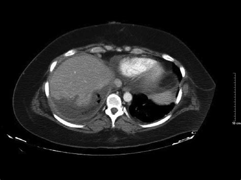 A Ct Scan Revealing Fluid Collection With Gas In A Patient Who