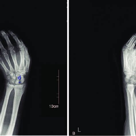 A D 3d Computed Tomography Scan Showing Lunate Dislocation And Download Scientific Diagram
