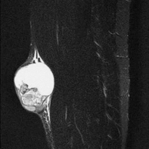 T2 Weighted Mr Imaging Shows A Solid Subcutaneous Mass Containing A