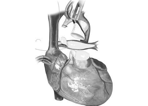 The Modified The American Association For Thoracic Surgery AATS