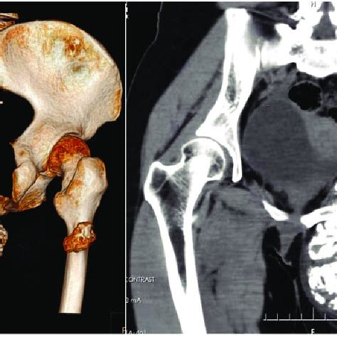 Three Dimensional Reconstruction Of The Patients Computed Tomography Scan Download