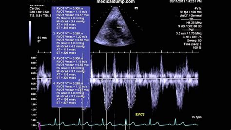 Pulmonary Valve Stenosis Echo