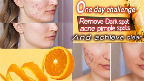 Remove Acne Pimple Overnight How To Get Rid Of Ance Pimple On Face
