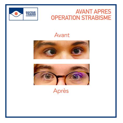 Le Strabisme Peut Sopérer Chirurgie Paupière