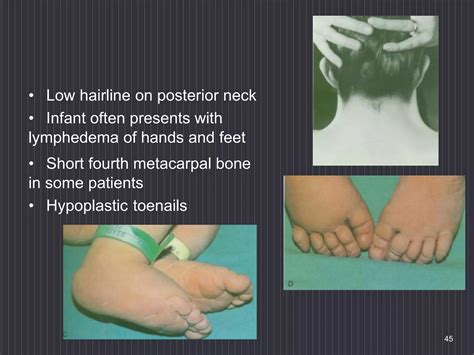 Developmental Anomalies Of Craniofacial Region Pptx