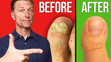 Get Rid Of Toenail Fungus Fast With Dr Bergs Tips