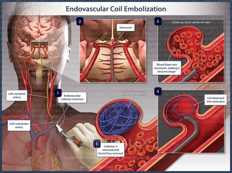 Endovascular Coil Embolization Female Trialquest Inc