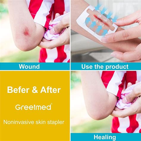 Greetmed Zip Stitch Sutures Butterfly Bandaids 4 Pcs Laceration