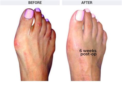 Lapiplasty Best Bunion Surgeon Los Angeles