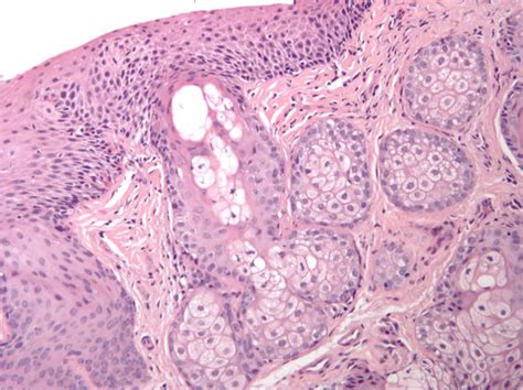 Sebaceous Gland Ectopia Of The Esophagus A Challenging Clinical Diagnosis In Vivo