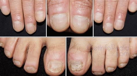 Nail Psoriasis And Its Treatment