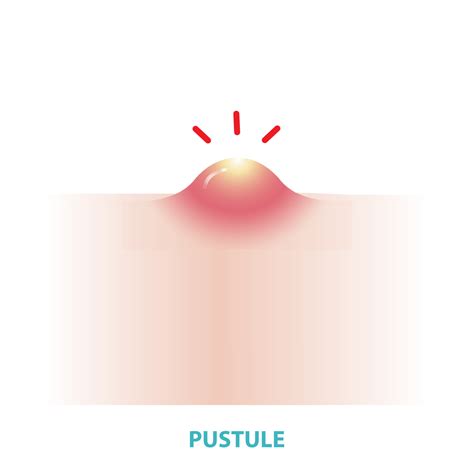 Pustule Pimple