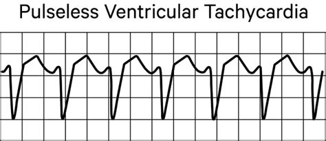 Pulseless Ventricular Tachycardia Ecg