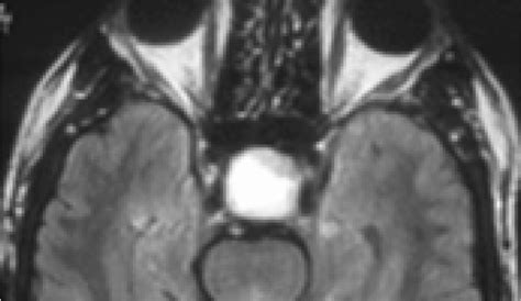 Trans Nasal Trans Sphenoidal Endoscopic Hypophysectomy Annals Of